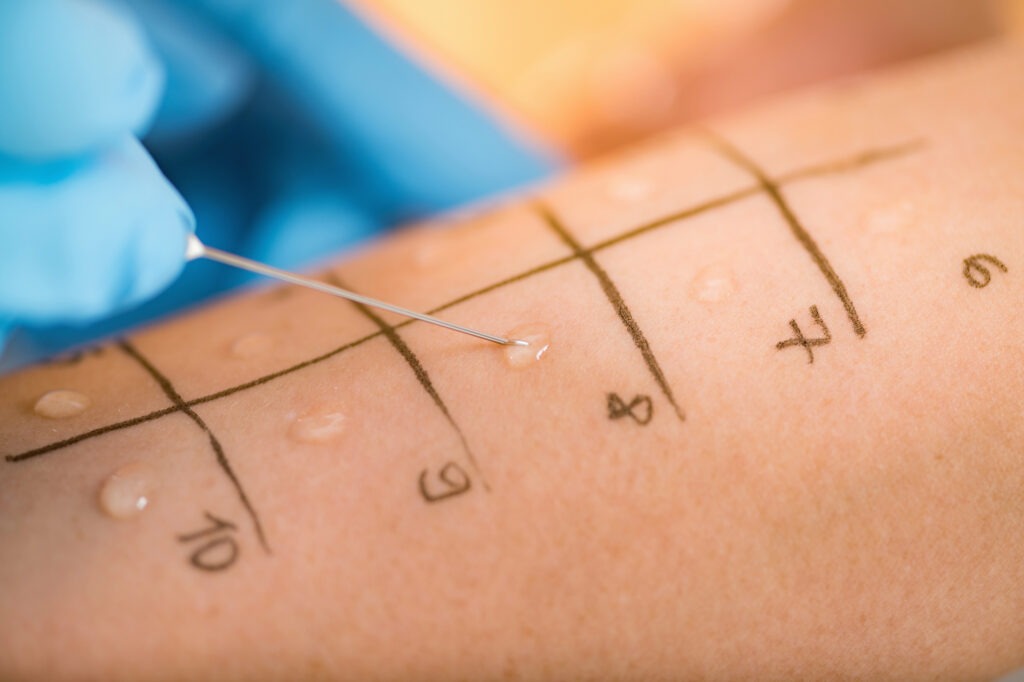 Allergy Testing & Treatment in Los Angeles | SoCal Sinus